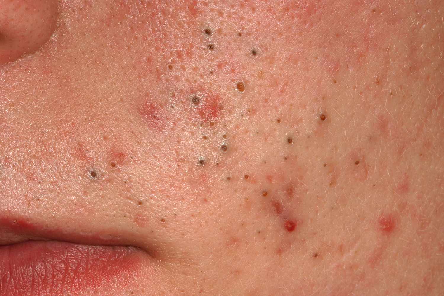 Seven (7) Things That Clog Your Pores And Cause Acne - Story News