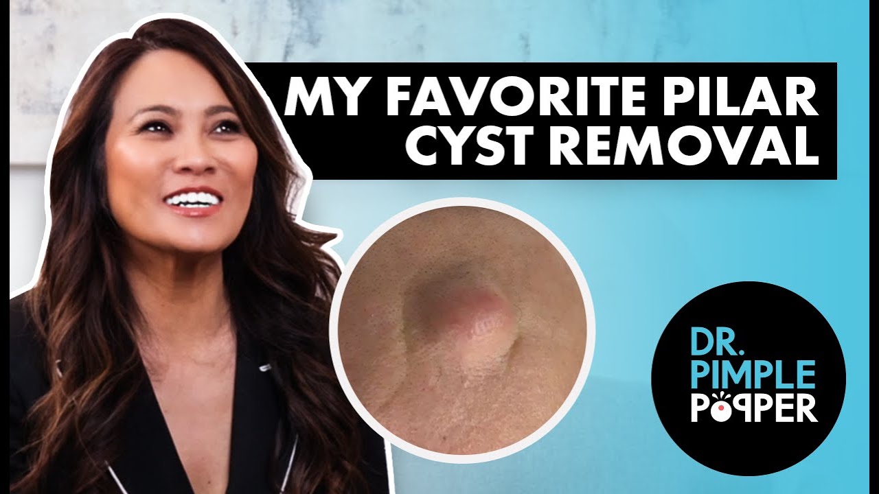 “Everything You Need to Know About Meatball Cysts” – Story News