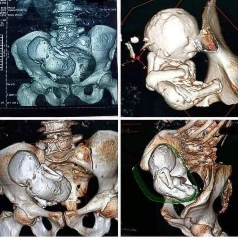 The Stone Baby: Doctors Discover 30-Year-Old Calcified Fetus in 73-Year ...